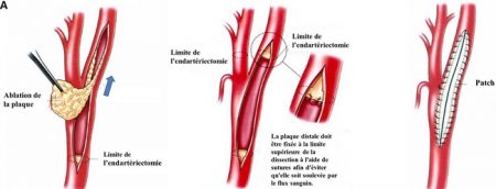 carotide-chirurgie-vasculaire-chirvtt-8 - Chirvtt