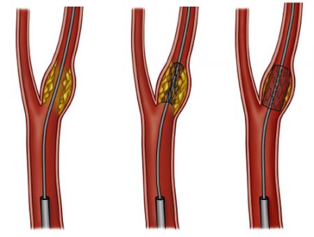 carotide-chirurgie-vasculaire-chirvtt-9 - Chirvtt