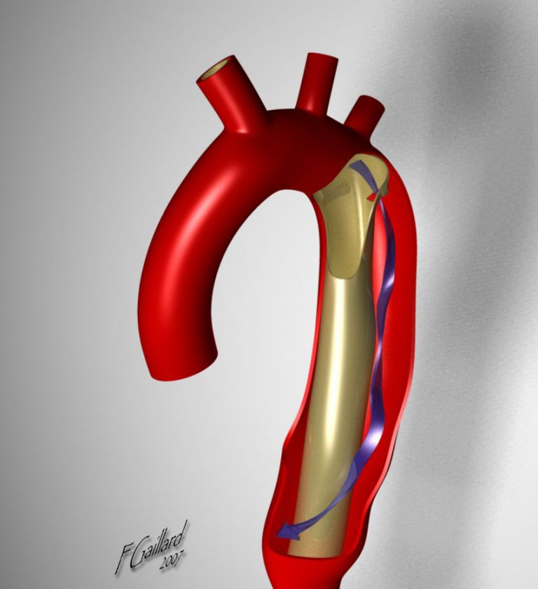 Chirurgie Aortique Thoracique | Opération De L’Aorte Traitement – ZZGH