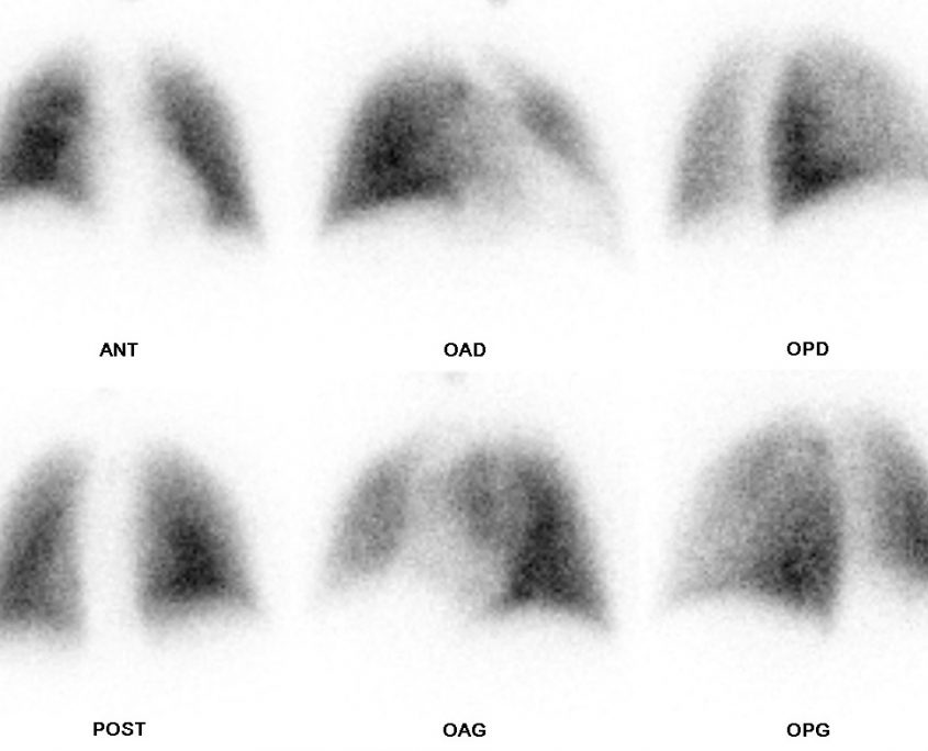 Explorations thorax : scanner, fibroscopie, endoscopie Hôp.Bichat ChirVTT
